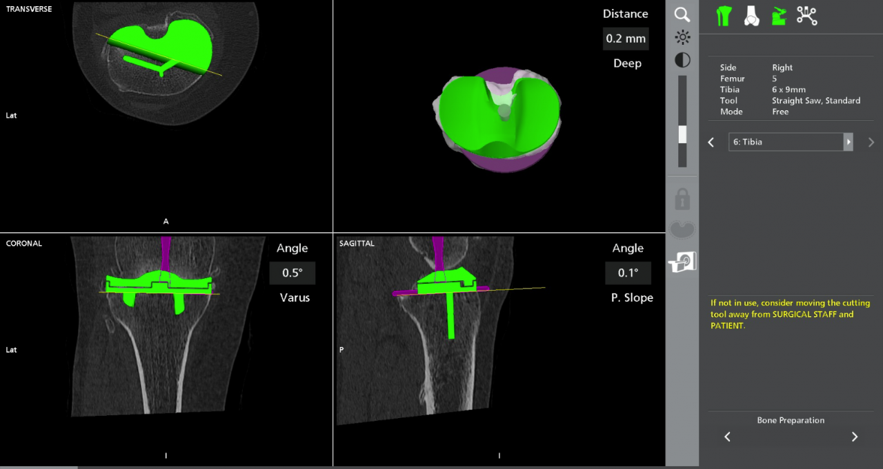 Total Knee Replacement Surgery | Total Knee Replacement | Hip & Knee Centre